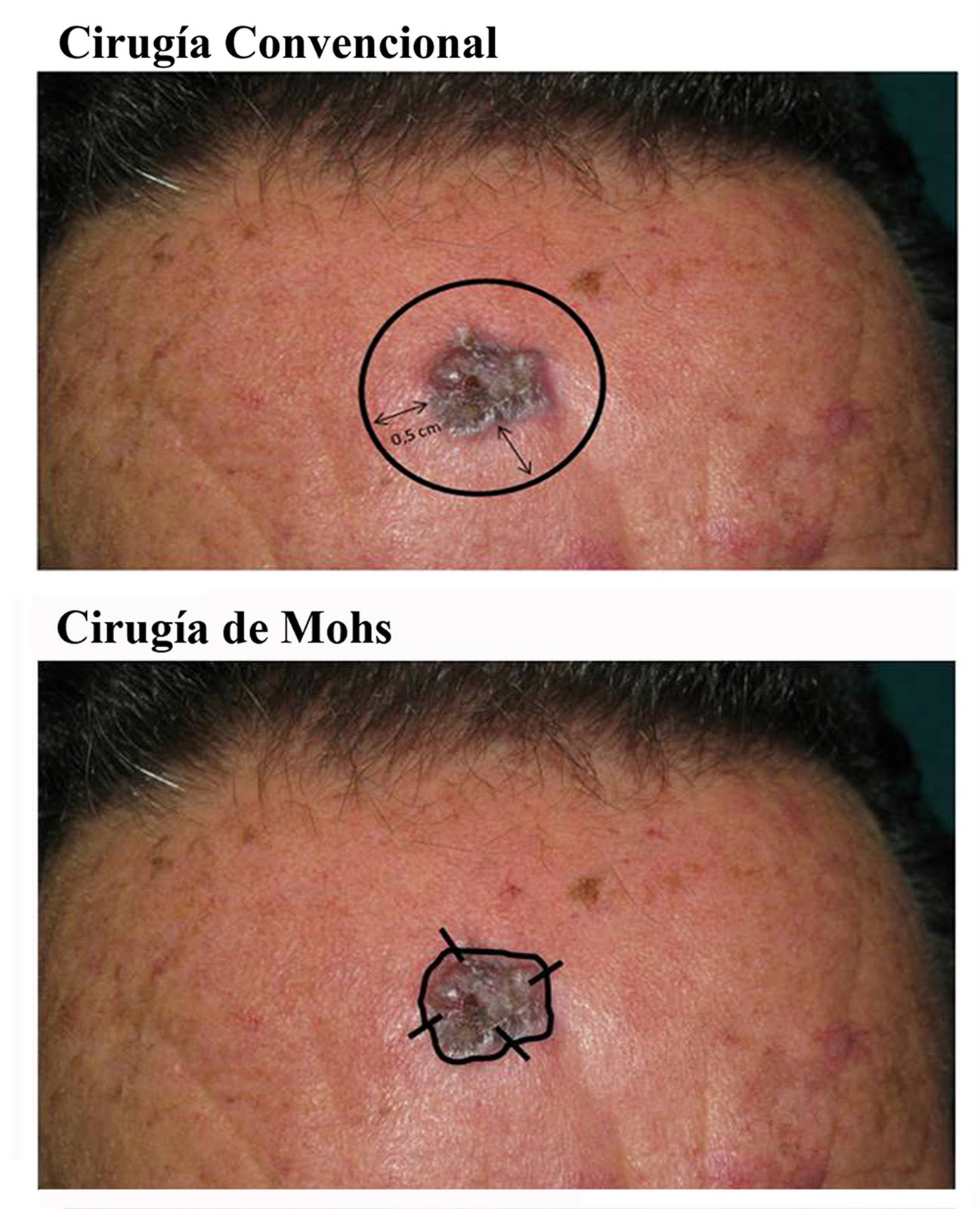 Noticias de Salud: Xanit Hospital Internacional incorpora la cirugía de Mohs, una técnica segura ...